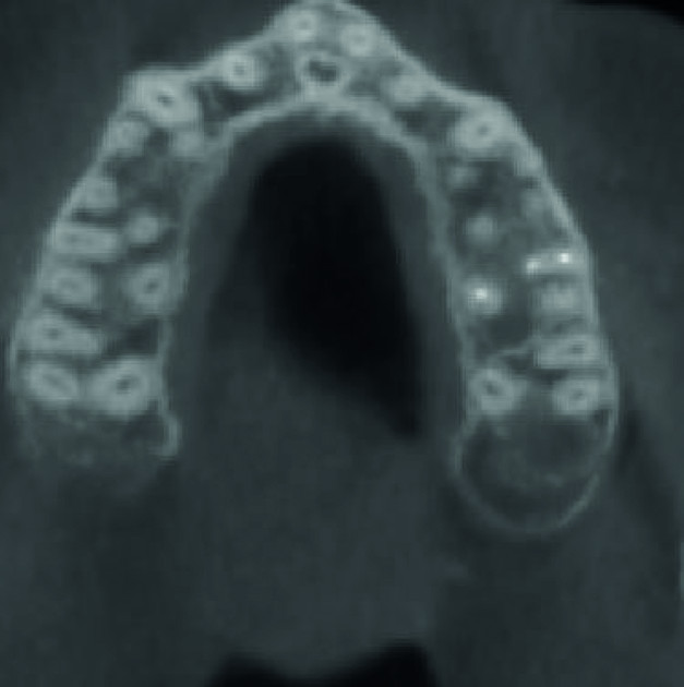 Dental News - Maxillary sinus and root canal therapy complications