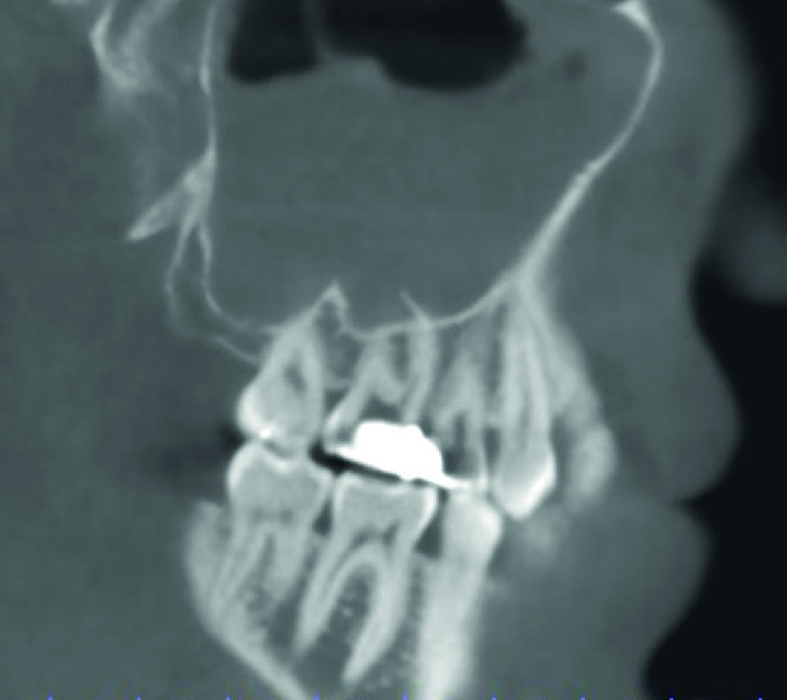 Dental News - Maxillary sinus and root canal therapy complications