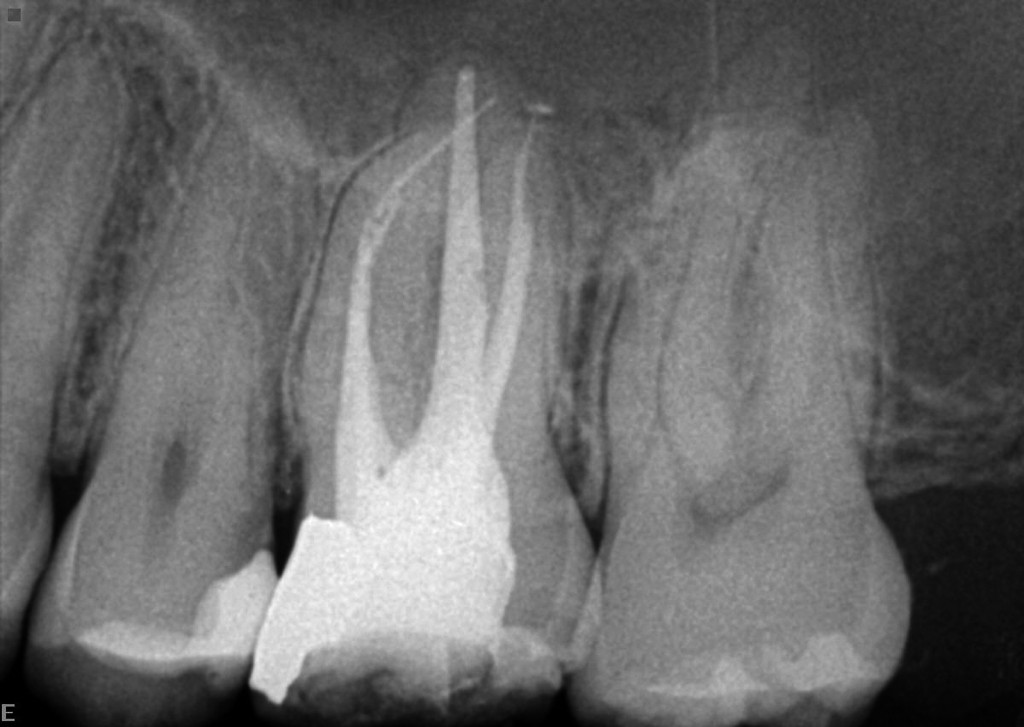 Dental News - Maxillary sinus and root canal therapy complications
