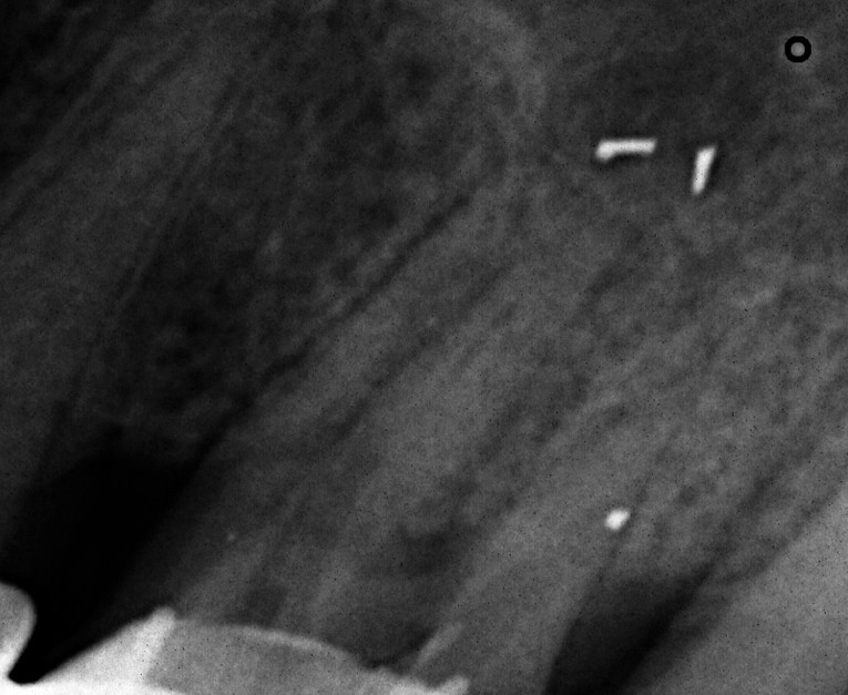 Dental News - Maxillary sinus and root canal therapy complications