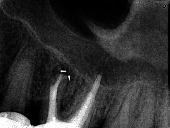 Dental News - Maxillary sinus and root canal therapy complications